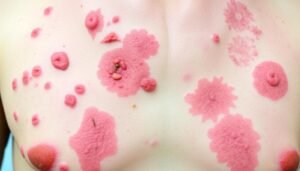 Lung Cancer Rash: Symptoms and Warning Signs – careyourlungs